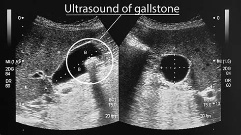 Gallbladder Ultrasound Purpose Preparation Results And More