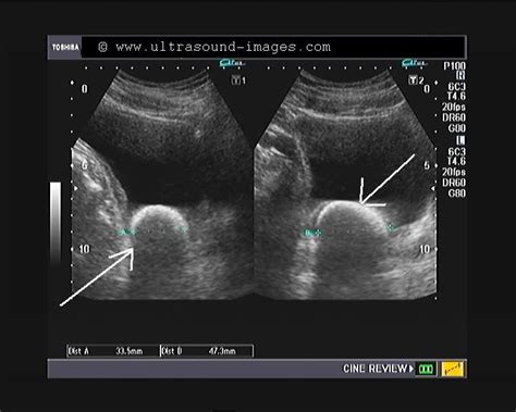 A Gallery Of High Resolution Ultrasound Color Doppler And 3d Images Urinary Bladder