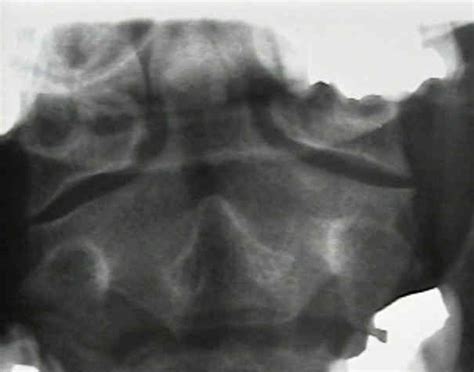 Odontoid View Wheeless Textbook Of Orthopaedics