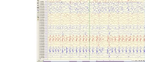 Subdural Grid Eeg Recording Showing Near Continuous Epileptiform
