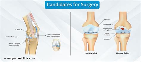 Partial Knee Replacement In Jaipur By Dr Arun Partani Clinic
