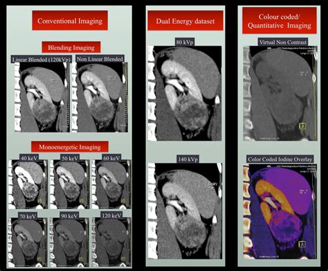 Dual Source Dual Energy Ct Images Representation In A Download