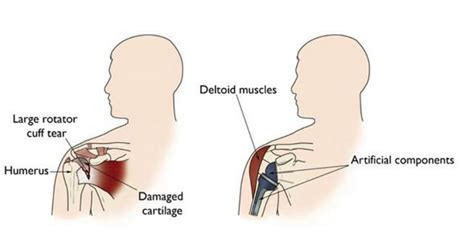 Verso Stemless Bone Preserving Reverse Shoulder Replacement With Orthopaedic Surgeon Mr Jai
