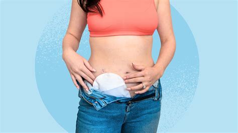 Sex With A Stoma Bag 5 Tips For Intimacy After Ostomy