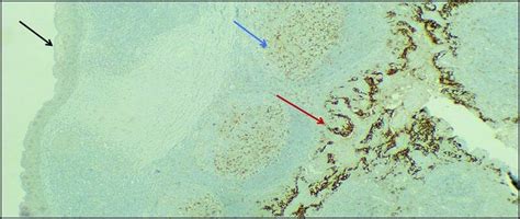 On Slide Positive And Negative Control Tonsillar Tissue The Cryptic