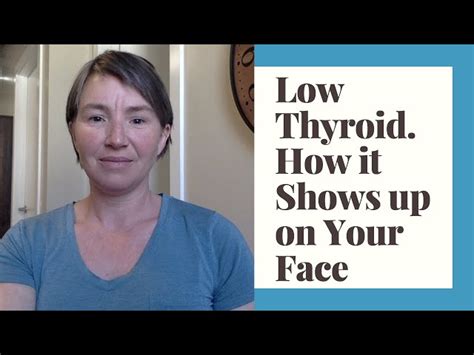 Hypothyroidism Before And After Face