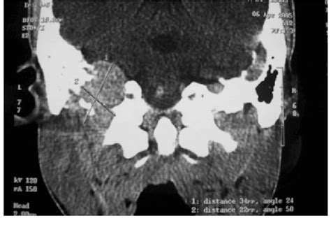Ct Scan Showing Glomus Jugulare Extending Intracranially Download