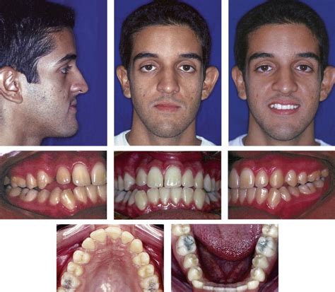 Maxillary Protrusion And Mandibular Retrusion