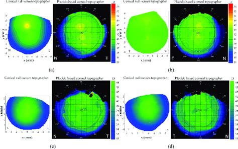 Tangential Curvature Maps A Left Cornea S1 B Right Cornea S1 C Download Scientific