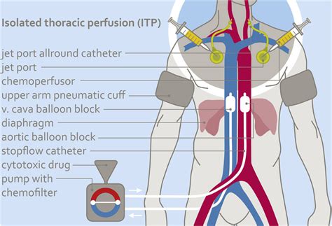 Scheme Of Isolated Thoracic Perfusion Aorta And Vena Cava Are Balloon