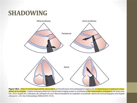 Assessment Of Prosthetic Valve Function Pptx