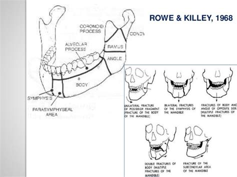 Mandible Fracture Classification Alila Medical Media Mandibular
