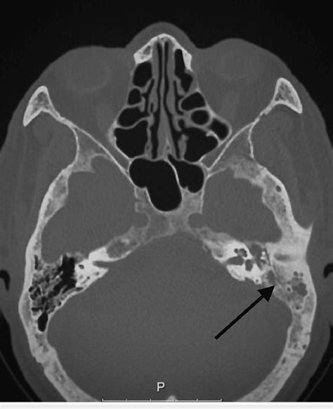 Ear Ct Revealing Skull Base Osteomyelitis And Left Otomastoiditis Download Scientific Diagram