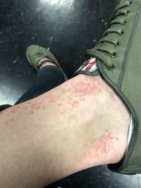 Red Spots On Ankles Captions Watch