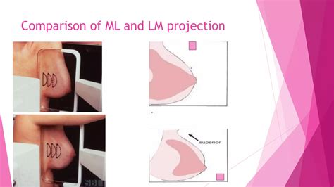 Mammography Positioning Technique For Lateral Views LM ML PPTX