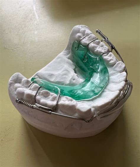 Spring Aligner Los Ortodonzia