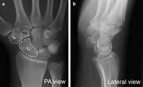 Scaphoid Fracture Zones At Tamara Wilson Blog