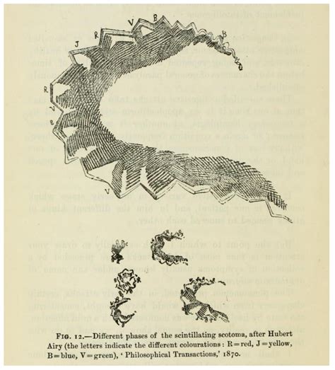 Scintillating Scotoma