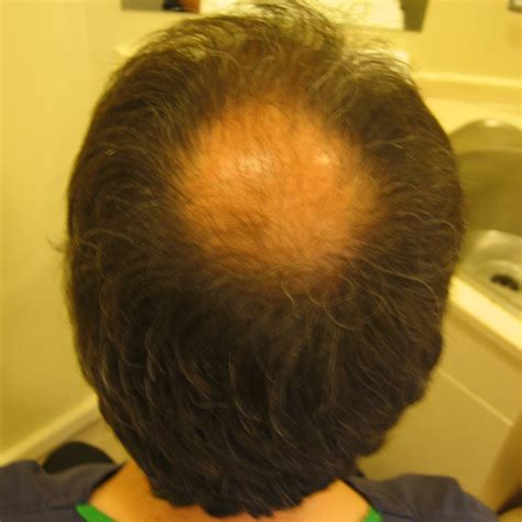 Facial Hair Growth Bald Spots At Lori Francois Blog
