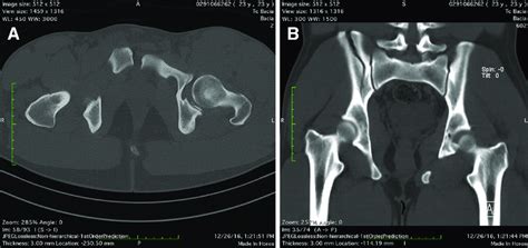 Pelvic Computed Tomography After Reduction A Axial Reconstruction Download Scientific
