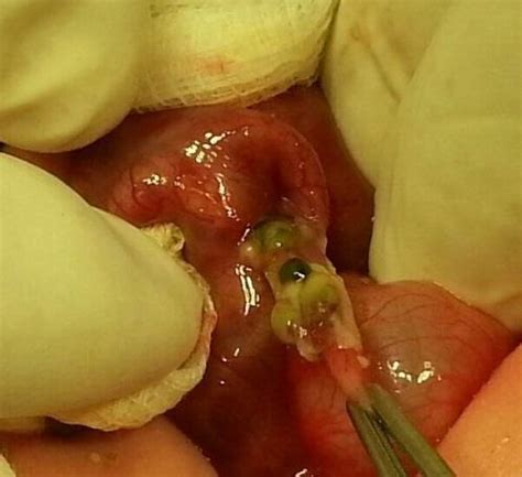 The Site Of Perforation Of The Appendix Intraoperative View Download Scientific Diagram