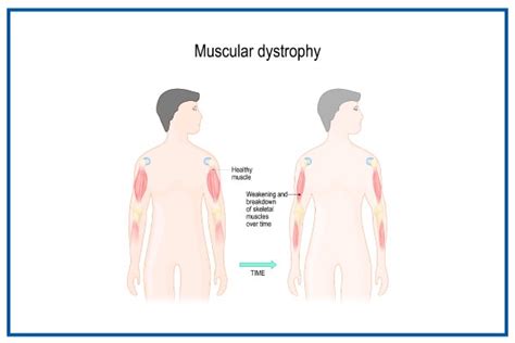 Distal Muscular Dystrophy Symptoms Quqk