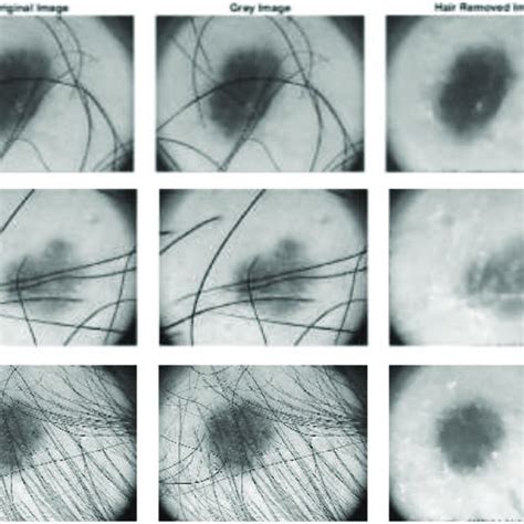 Image Before And After Applying Hair Removal Algorithm Download