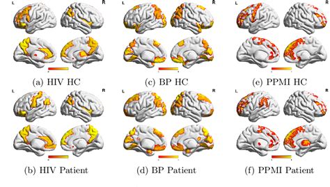 Table 1 From Interpretable Graph Neural Networks For Connectome Based Brain Disorder Analysis