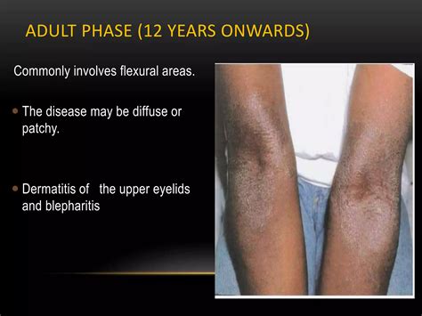 9 Eczema And Dermatitis Pptx Skin And Dermatology Diseases And Conditions 9 Eczema And Dermatitis Pptx Skin And Dermatology Diseases And Conditions