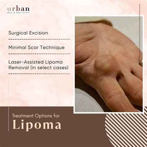 Lipoma Removal Treatment In India Clinic Ushc