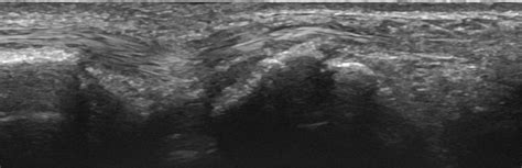 Clone Of Extensor Tendon Compartments Longitudinal Sonotool®