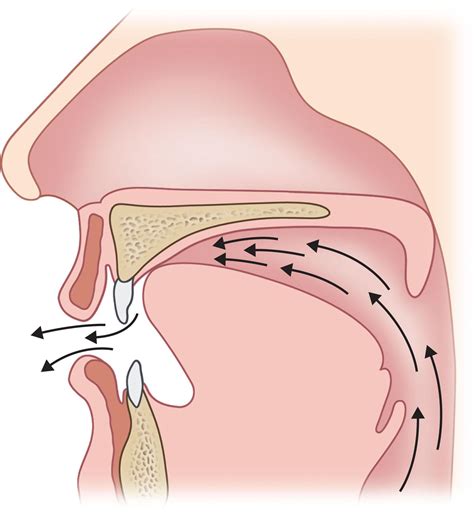 Velopharyngeal Dysfunction Clinical Tree