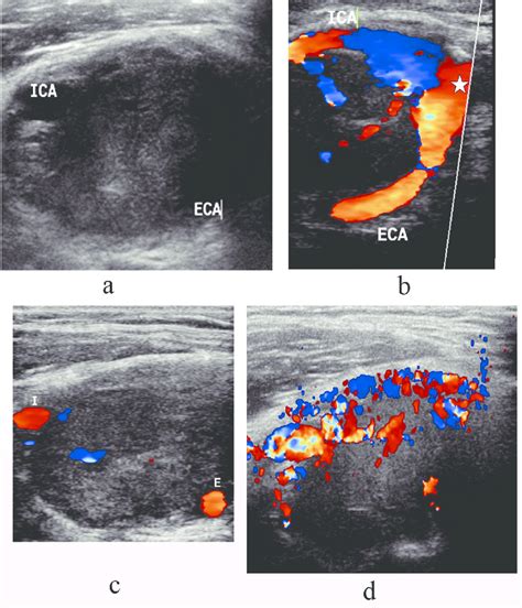 A D B Mode Sonography Showing A Solid Well Defined And Hypoechoic Download Scientific