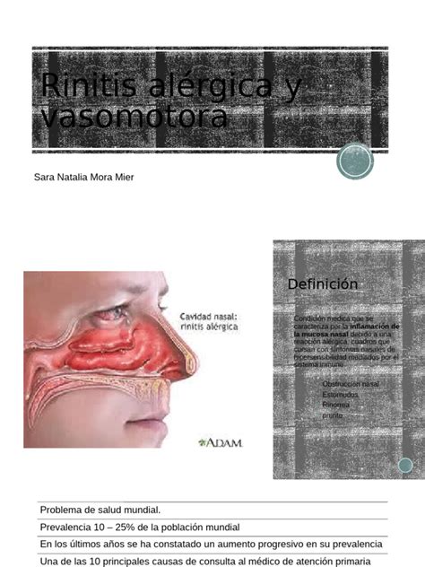 Rinitis Alergica Y Vasomotora Pdf