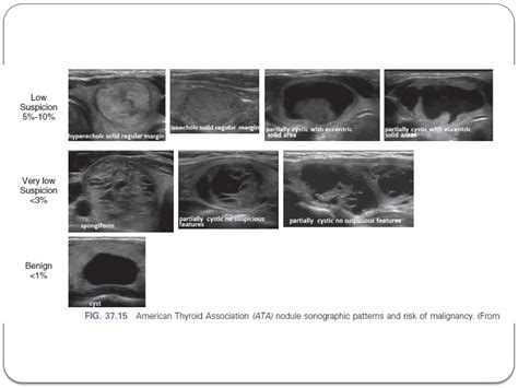 Lecture 1 Evaluation Of Thyroid Nodule Pptx