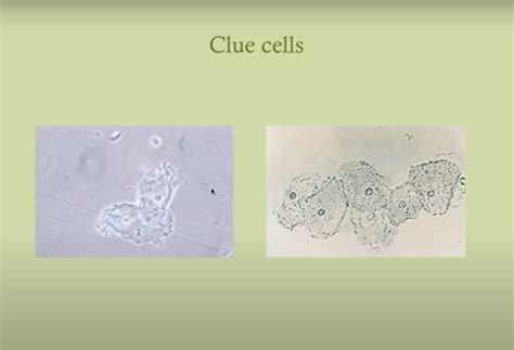 Bacterial Vaginosis Bv Discharge Pics Infection Vaginitis Std