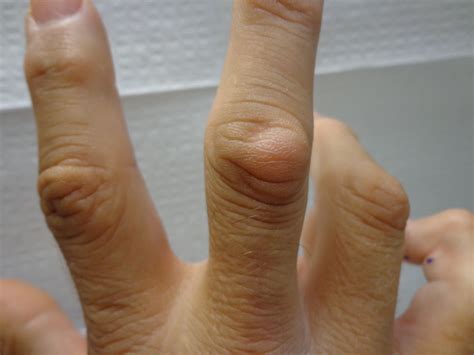 Dupuytrens Knuckle Pads Dorsal Dupuytren Nodules Atelier Yuwa Ciao Jp