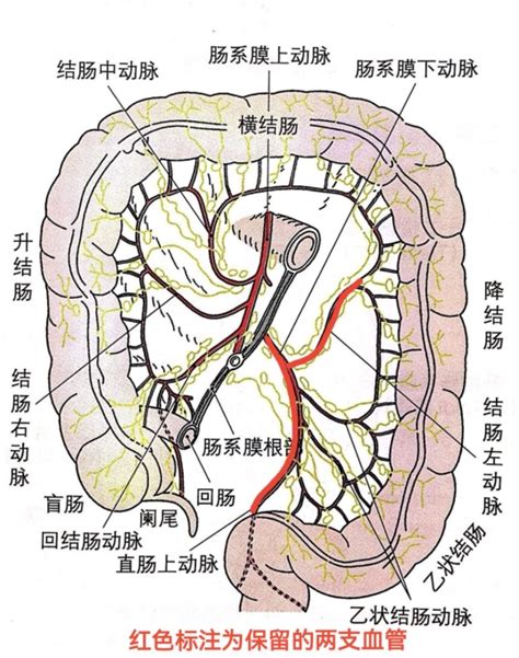 呼和浩特市第一医院胃肠外科新技术分享腹腔镜下同时保留左结肠动脉和直肠上动脉的乙状结肠癌根治术 呼和浩特市第一医院