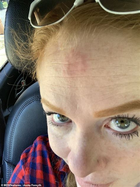 Skin Cancer On Forehead