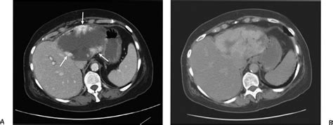 Hepatic Hemangioma Ultrasound Radiology