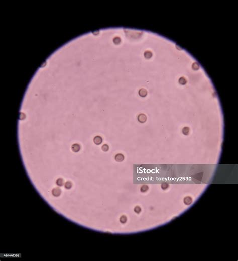 Sel Darah Merah Segar Dalam Spesimen Urin Di Bawah Mikroskop 400x Foto