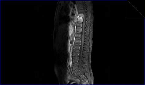 Discitis Mri Radiology Article On How To Report Spondylodiscitis