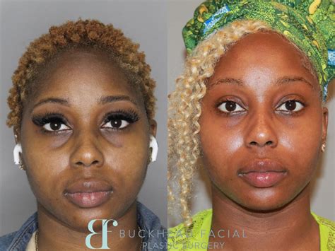 Prf Injections Before And After Photo Gallery Atlanta Georgia