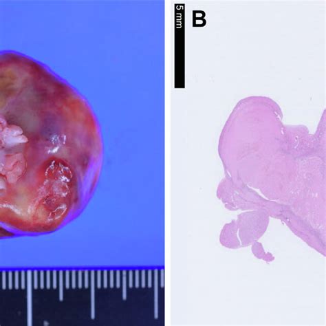 Transesophageal Echocardiogram Of Right Atrium Download Scientific