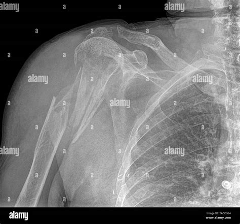 Broken Upper Arm Bone Frontal X Ray Of The Fractured Right Humerus Upper Arm Bone Of An 85
