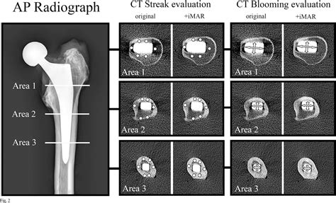 Figure 2 From Influence Of Scan Parameters Of Single And Dual Energy Ct