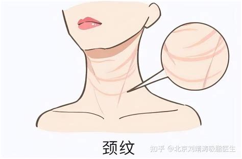 产生颈纹的原因有哪些嗨体去颈纹好吗 知乎