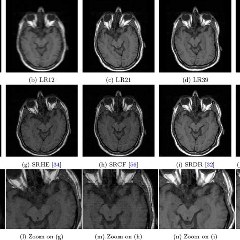 Comparisons Of Reconstructing Mri Knee Image With Different Sr Methods