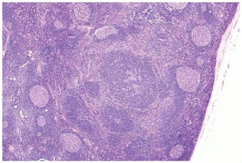 The Lymph Nodes Spleen And Thymus Basicmedical Key