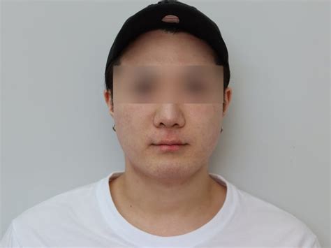 남자 수염레이저 제모 젠틀맥스프로플러스 5회 솔직 후기 네이버 블로그